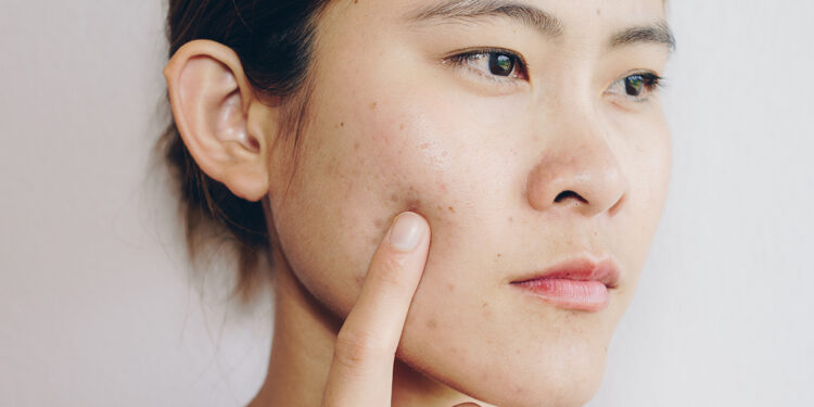 A Deep Dive into Skin Blemishes and Their Treatments